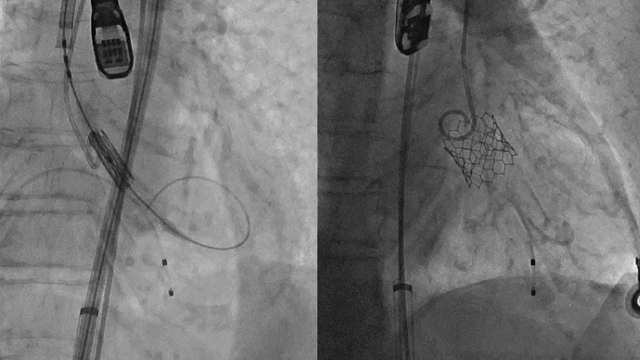Challenging cases with SAPIEN3 Vol II – heavy calcified annulus, narrow ...