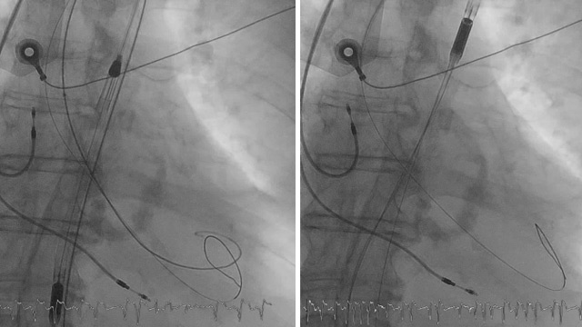 Challenging interventional procedures in cardiogenic shock and acute ...