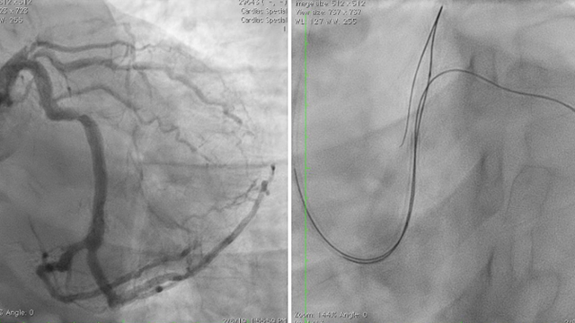 Complex PCI - Trifurcated lesion, MVD & calcified SVG