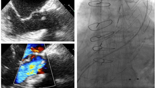 Complex TAVI procedures: valve-in-valve