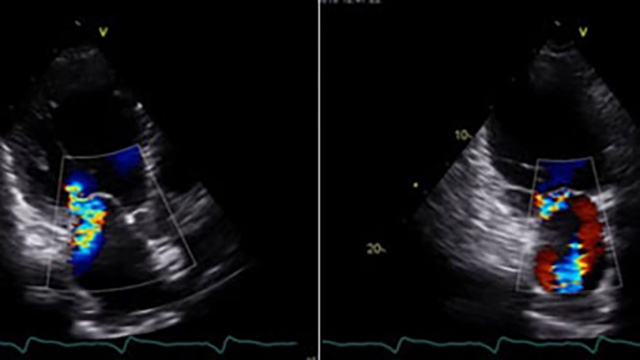 Complex transcatheter valve interventions