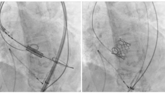 TAVI (Transcatheter aortic valve implantation)