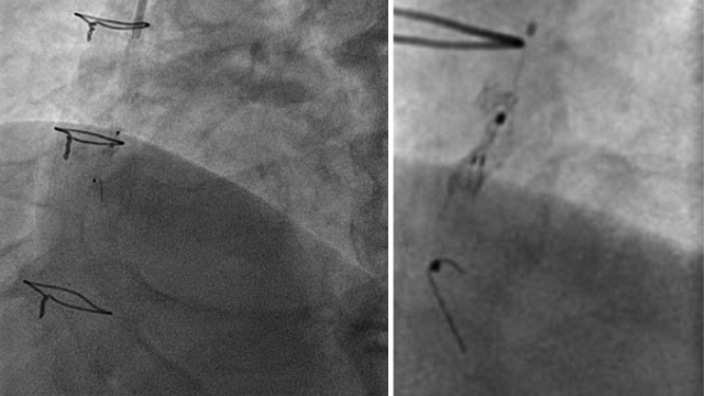 Complications - Trapped filter, stent dislodgement, intramural hematoma