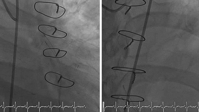 Dealing with a failing graft - Challenges and solutions