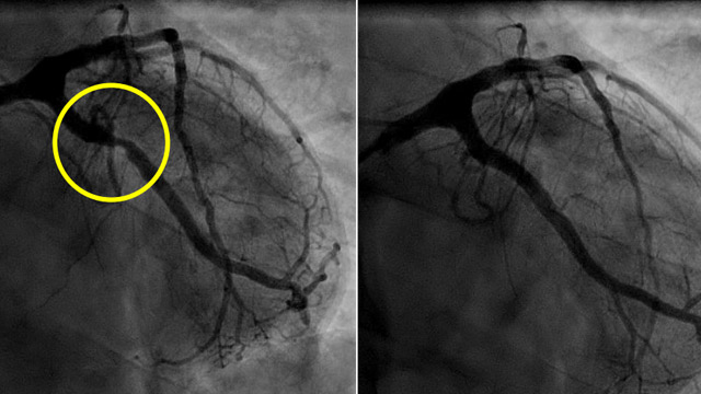 DynamX Bioadaptor, the new frontier beyond stenting for PCI