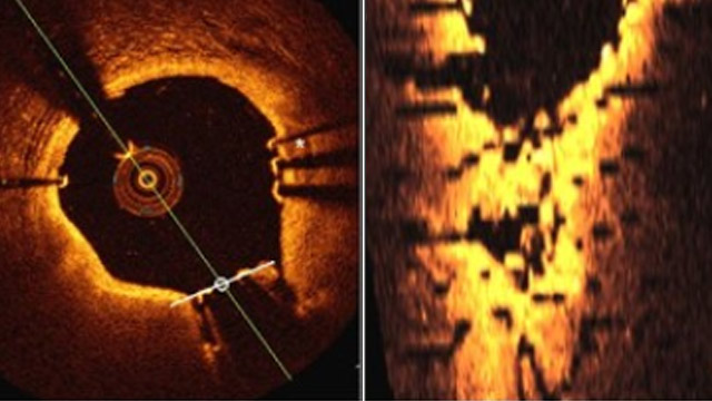 Exploring evidence and experience with magnesium scaffold Magmaris