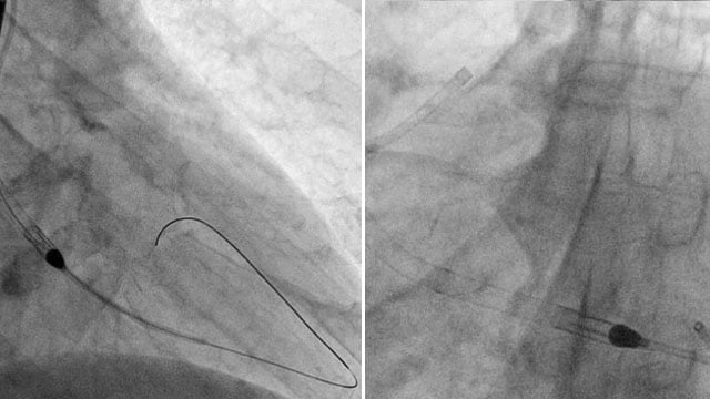 High-risk PCI with mechanical circulatory support