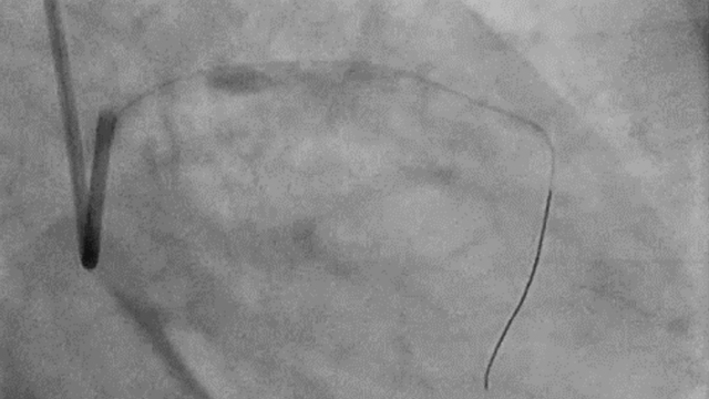 How Should I Treat? - Complications in complex PCI