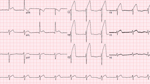 Nstemi Stemi / Current ED Management of Non-ST Segment Elevation MI ...