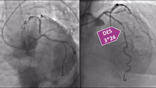 How to manage PCI in patients treated with oral anticoagulant?