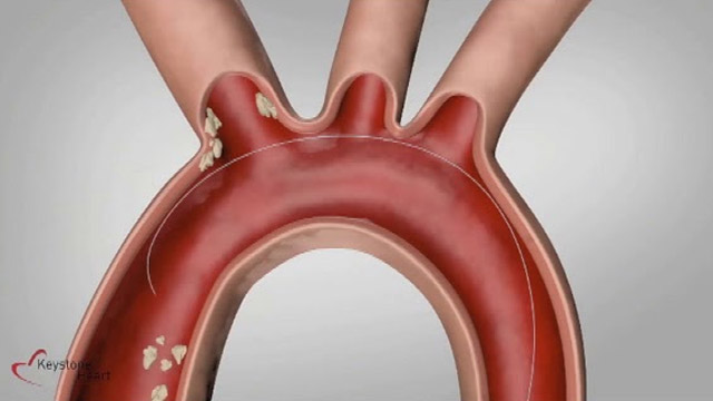 Latest developments in cerebral embolic protection