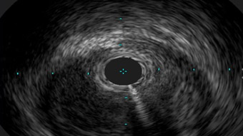 Left main bifurcation stenting: a case-based approach