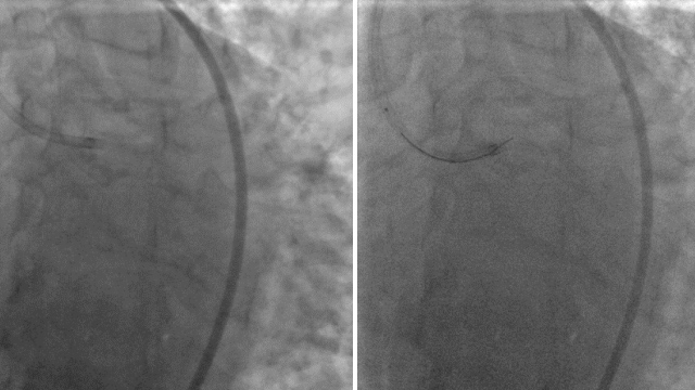 Left main bifurcation: strategies, procedures and treatments