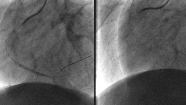 Magnesium scaffolds: Magmaris technology and clinical evaluation