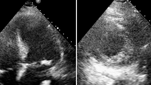 Management of coronary complications after TAVI