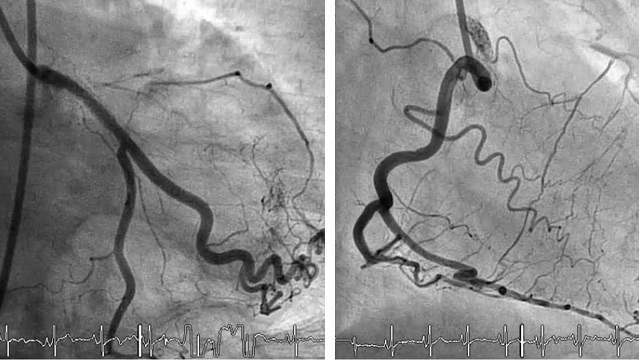 Management of in-stent restenosis: importance of imaging