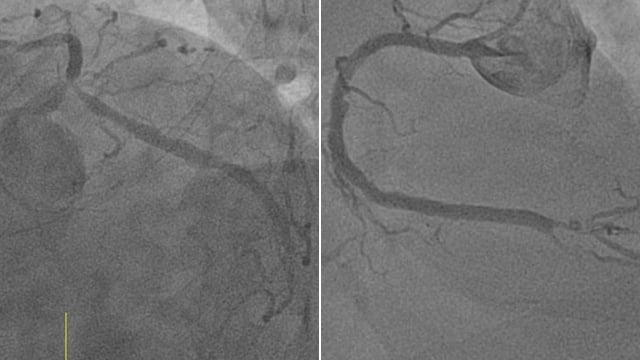 Meaningful solutions for complex patients: IVUS HD guided left main ...