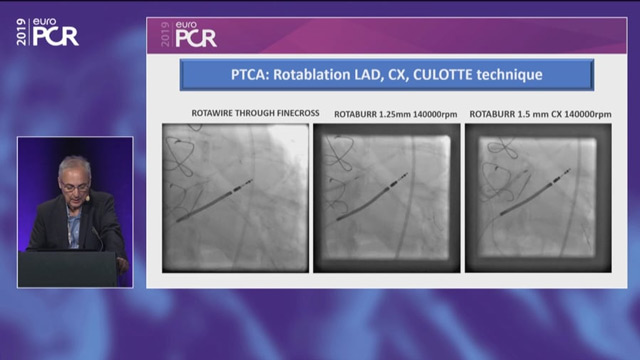 Mechanical circulatory support for protected high-risk PCI: when and how?