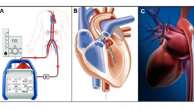 Mechanical circulatory support: when, why and how in cardiogenic shock