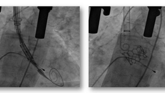 My first TAVI procedures - Management of femoral access