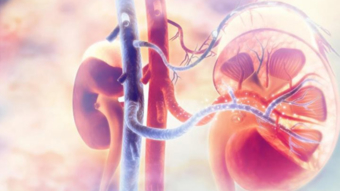 Renal denervation (RDN)