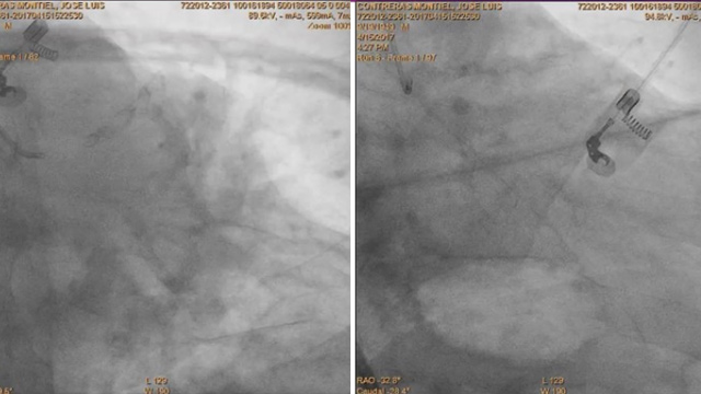 PCI complications in daily practice: patient, device or doctor?