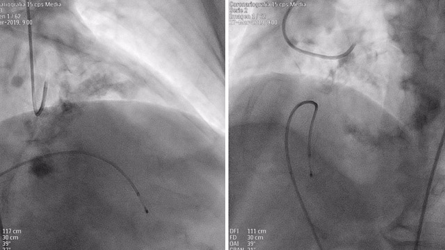 Precision meets simplicity – Complex PCI guided by a 2nd generation ...