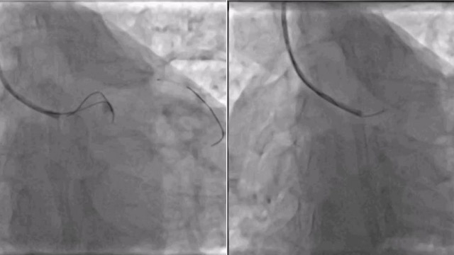 Prevention and management of iatrogenic coronary dissection - Part 1