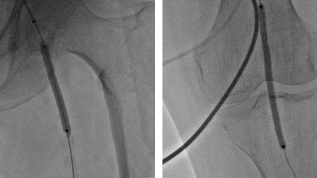 Retrograde access and transcollateral technique for below-the-knee ...