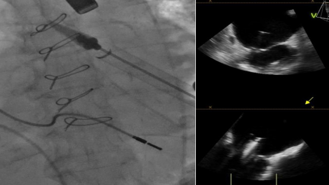 Shaping the future of transcatheter valve interventions