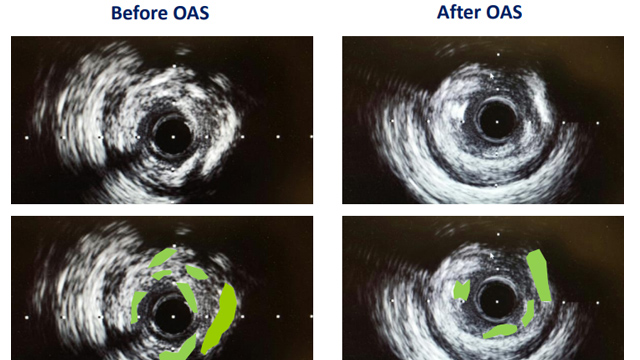 Simplify the complex: lesion modification and short DAPT flexibility in ...