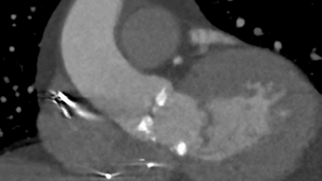 Some important tactical and technical aspects of TAVI