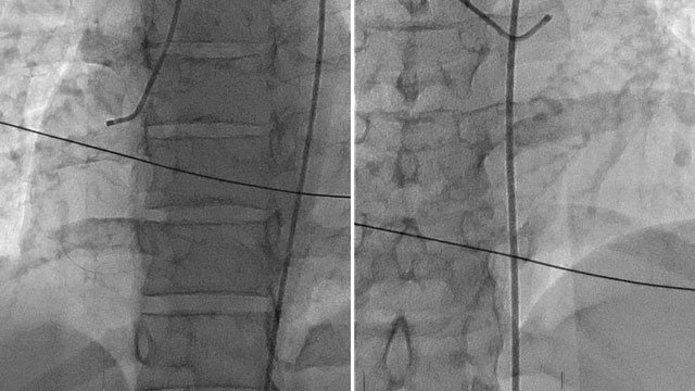 STEMI cardiogenic shock and ventricular fibrillation: a combination