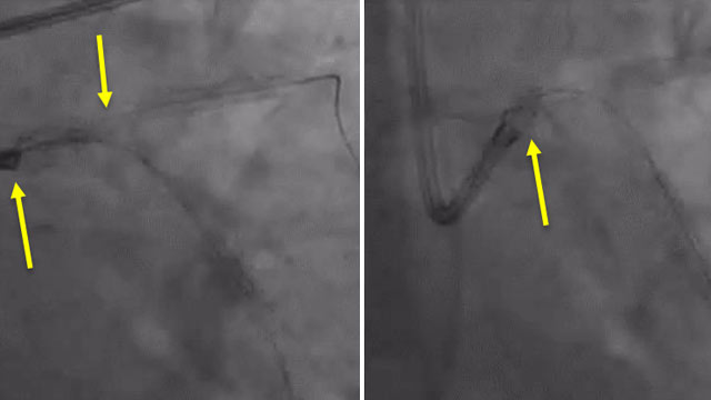 Stent dislodgement still happens! - Part 2