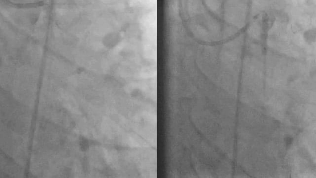 Stent dislodgement still happens! - Part 3