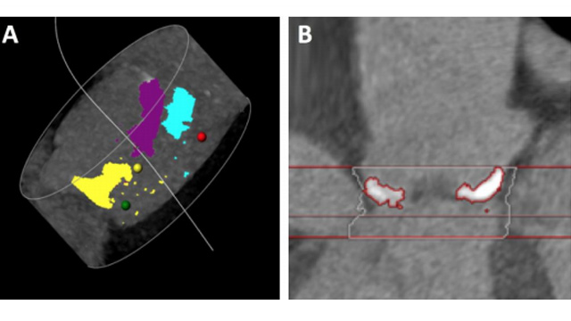 TAVI: imaging and topics