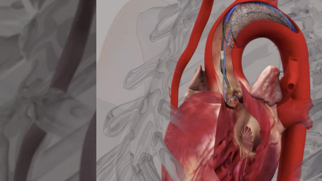 TAVI: stroke, cerebral protection and alternative vascular access