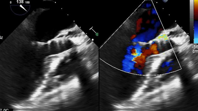 Challenging cases and complications in TAVI
