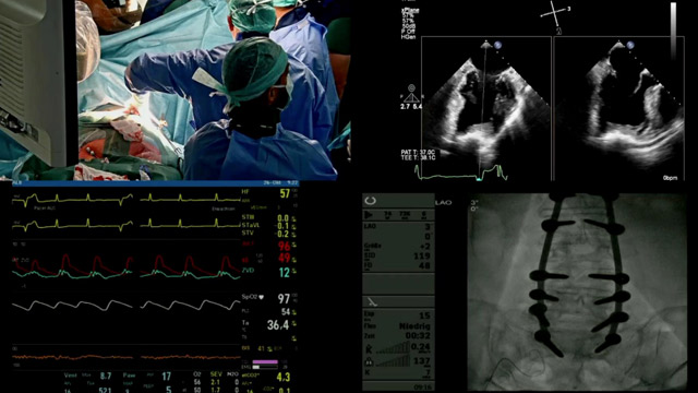 Tendyne - Journey toward a tailored transcatheter therapy selection ...