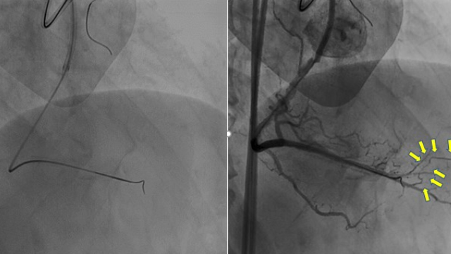 Towards performing a successful CTO procedure: making sense of all the ...