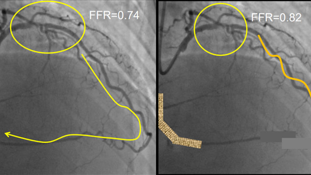Using physiology to determine coronary intervention in Stable Coronary ...
