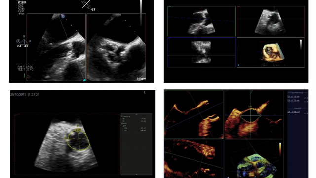 What will be relevant for TAVI assessment in 2020?