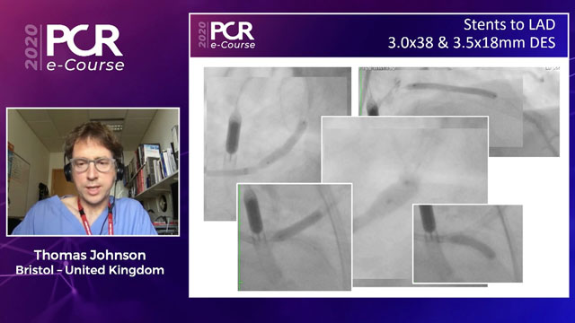CABG or PCI in patients with left main coronary artery disease