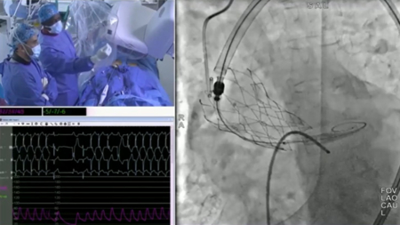 Access closure: ProGlide device