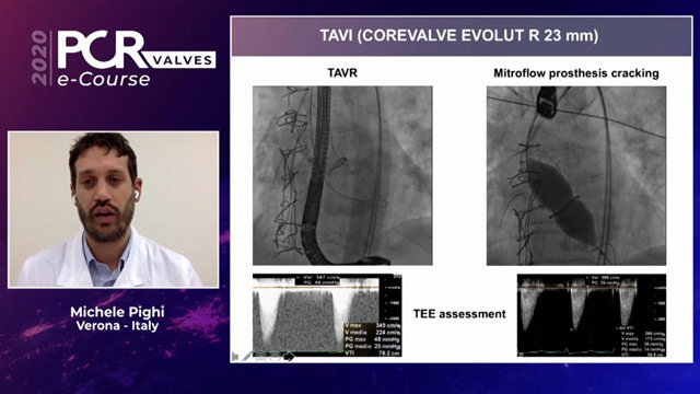 PCR Valves e-Course 2020 best TAVI cases - session I
