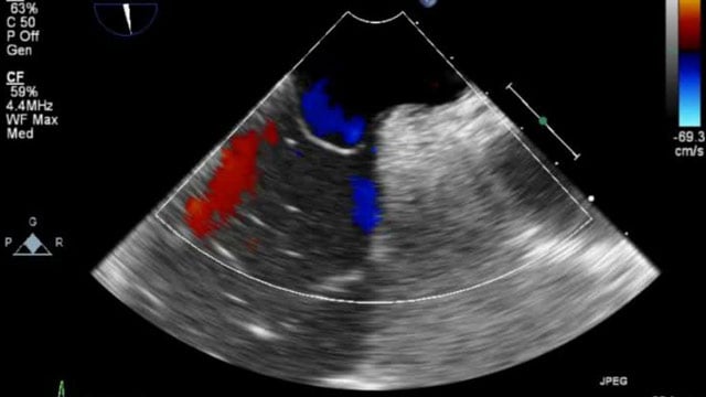 Stroke Prevention Day - PFO