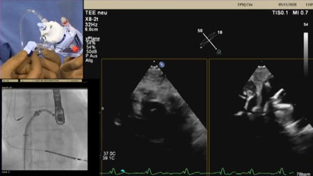 COAPT: 3-year outcomes from a randomized trial of the MitraClip in ...