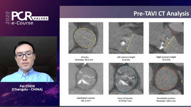 TAVI clinical cases - session I
