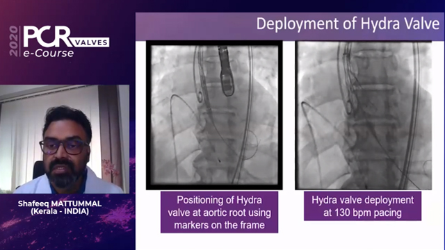 TAVI clinical cases - session II