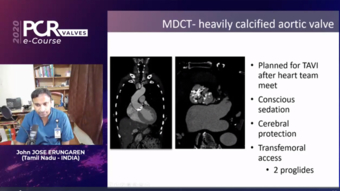 TAVI (Transcatheter aortic valve implantation)